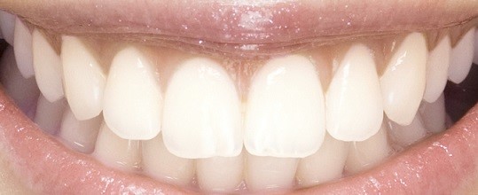 Porcelain margins - RAD Dental